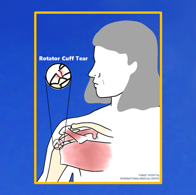 📖Susan's Journey to Recovery: Overcoming Rotator Cuff Tear - Medical ...